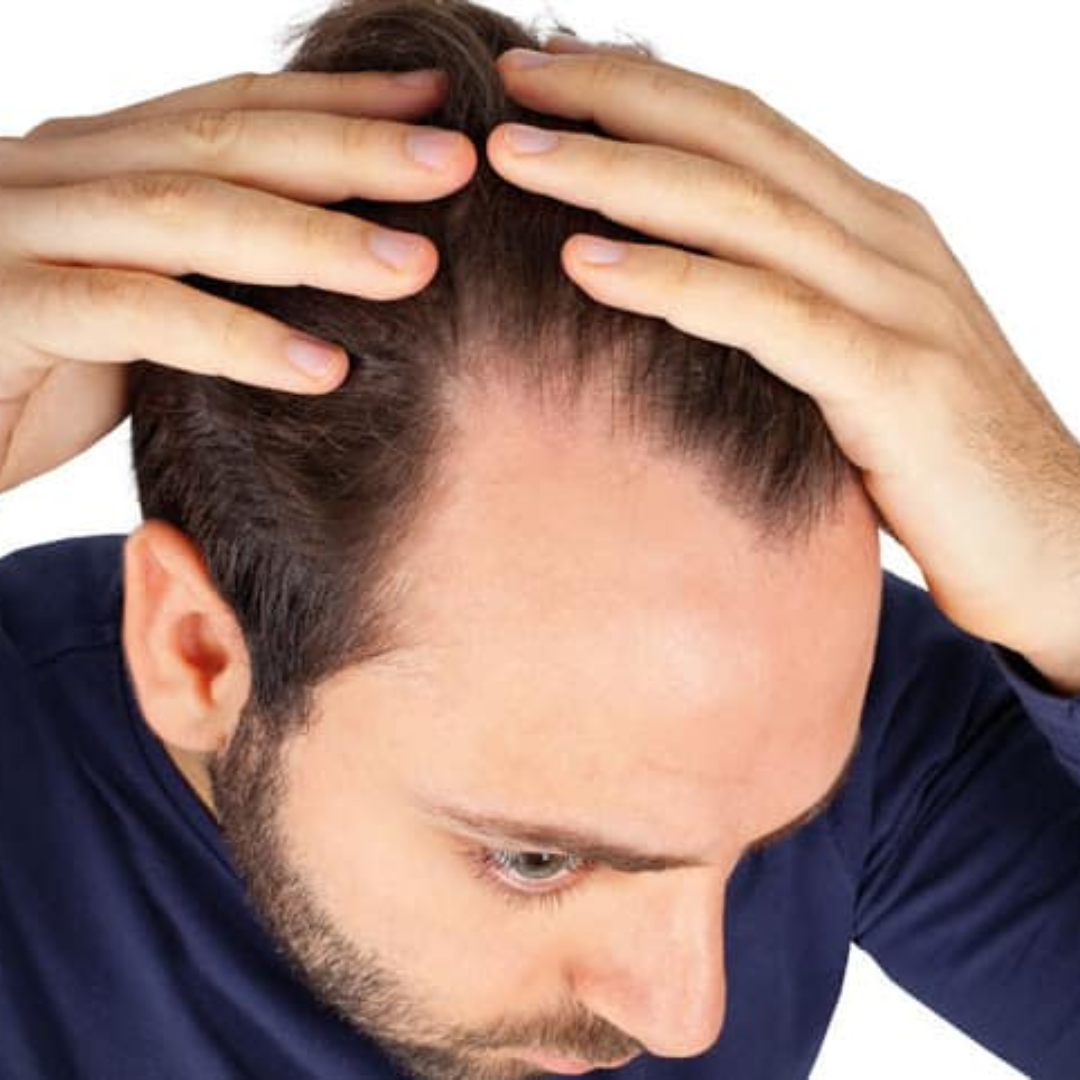 Perte de cheveux chez l'homme 1 – Clinique capillaire Noémie Sincerny